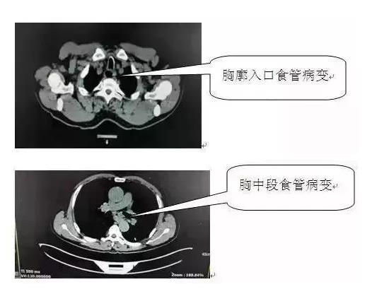 胸外科完成复杂食管癌全食管切除手术一例 天津市第一中心医院 站群网站发布
